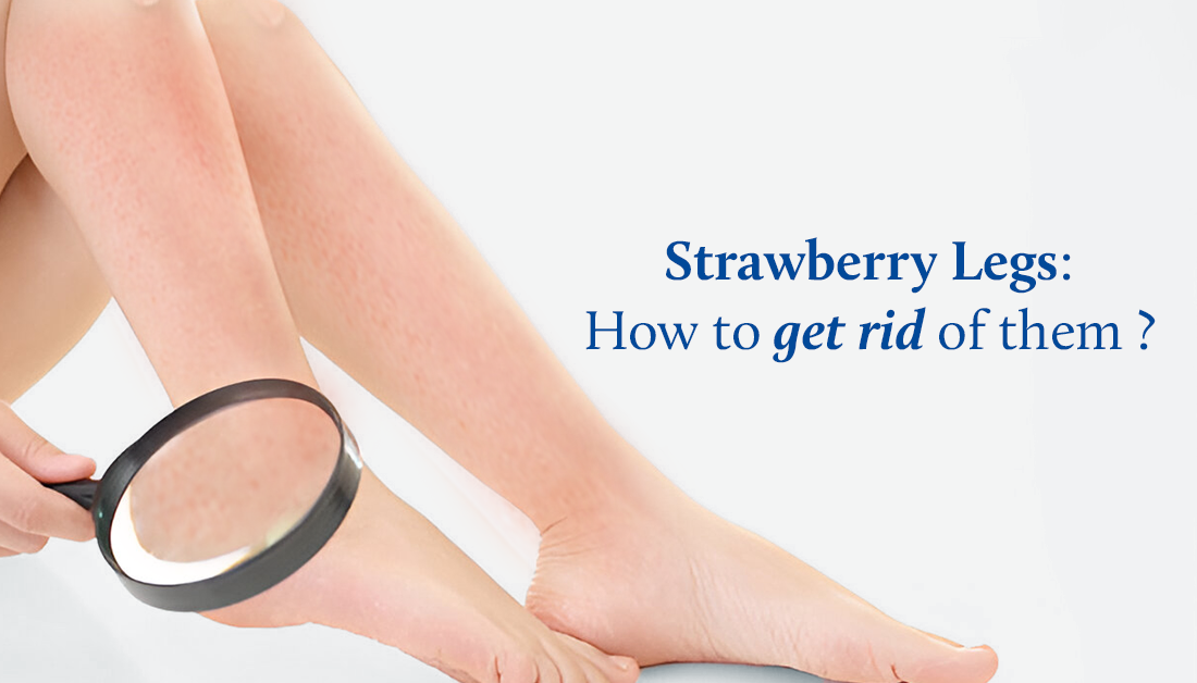 Preventing and Treating Strawberry Legs and Strawberry Skin. – Blue Nectar