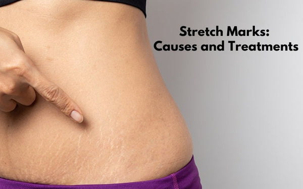 Stretch Marks: How to get rid of them and Causes? – Blue Nectar