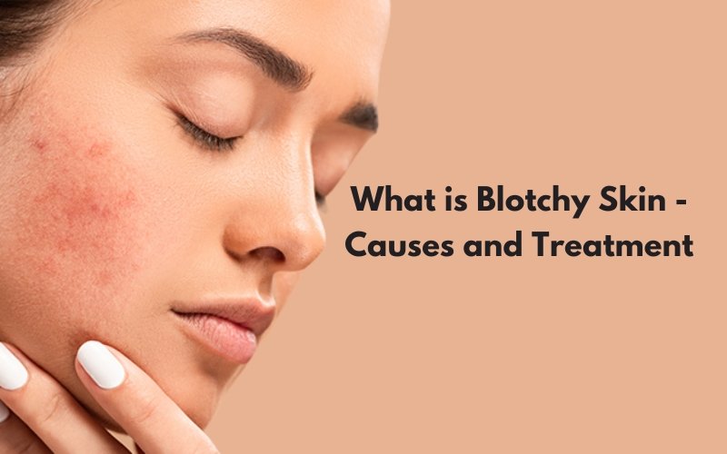 How to get rid of blotchy skin? – Blue Nectar